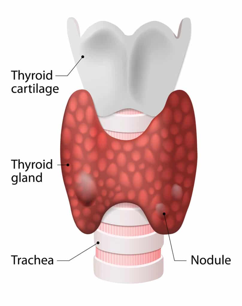 Understanding Thyroid Nodules: Evaluation and Treatment